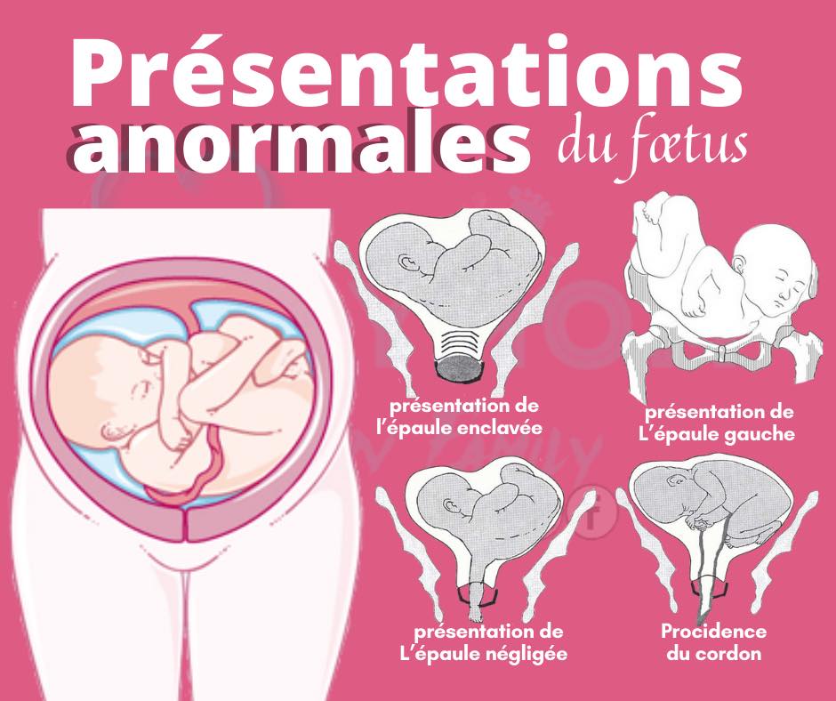 Présentations ANORMALES du fœtus. – Babymom237